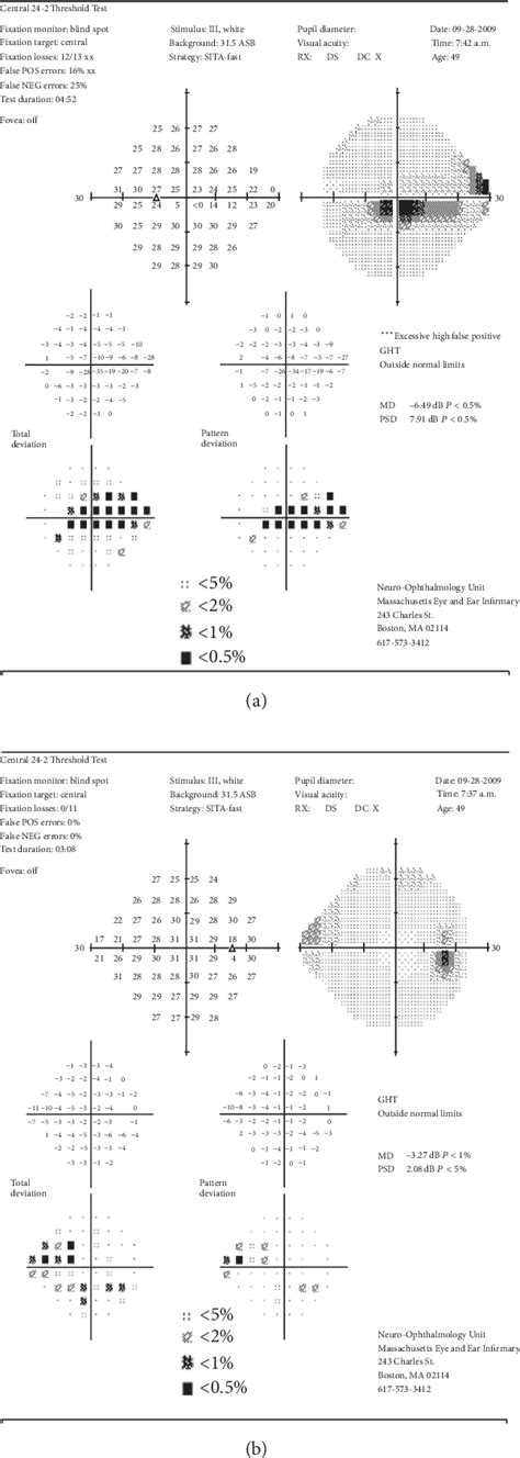Figure 1 From Optic Disk Pit With Sudden Central Visual Field Scotoma Semantic Scholar