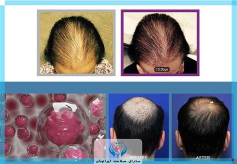 کاشت مو سلول بنیادی زمان آغاز فاز انسانی سلول بنیادی مو کلینیک