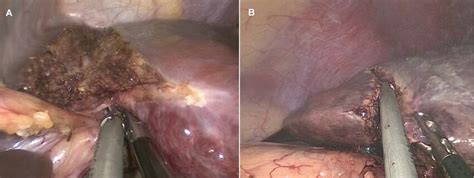 The Laparoscopic View During Left Lateral Sectionectomy A And Partial