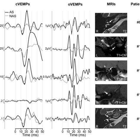 Demographic Data OVEMP And CVEMP Asymmetry Ratio AR Results And Download Scientific Diagram