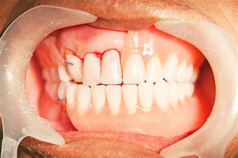 Recovering From Bad Gum Disease Qltura