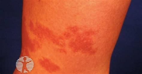 Vascular Malformation Image