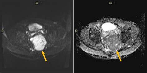The Pelvic Lesion Shows Restriction On Diffusion And Apparent Diffusion Download Scientific