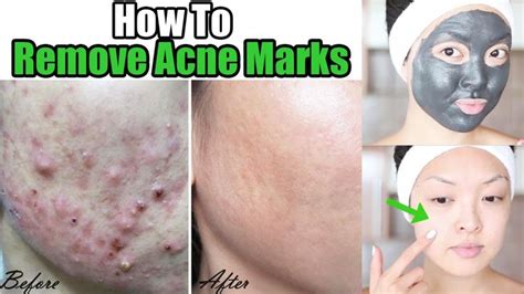 Remove Acne Marks Easy Quick Ways To Remove Acne Marks At Home Acne Marks Remove Acne
