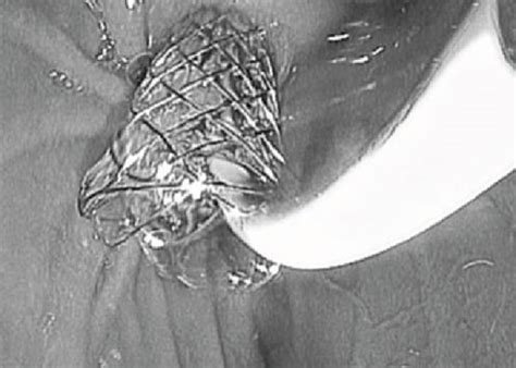 Surgical Procedure Of Ercp In The Treatment Of Biliary Strictures After Download Scientific