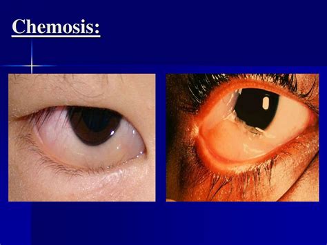 Ppt Optometry 8260 Fall 2007 Bacterial And Viral Infections Of The