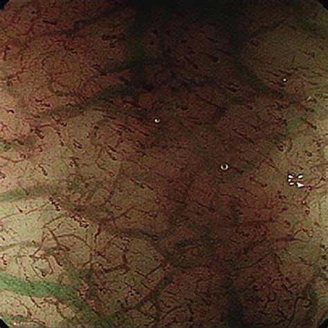 Original Intrapapillary Capillary Loop Ipcl Pattern Classification Download Scientific