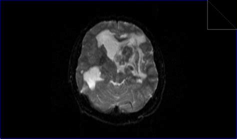 Central Nervous System Tuberculosistb Mri