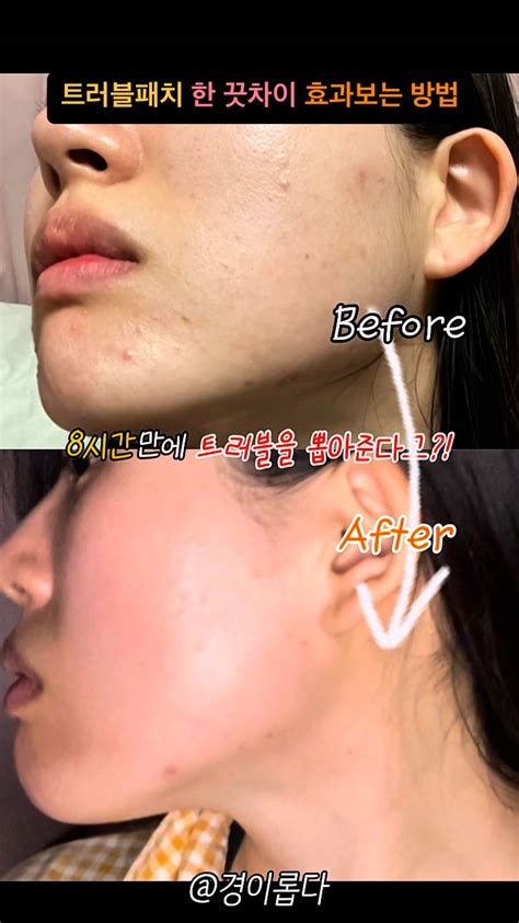 경이롭다 뷰티 • 여드름 • 관리 일단저장 아니 자는 동안 잡티흔적이 케어된다고 잡티흔적 때문에 고민이라 요즘 꾸준히 이거 쓰고 있어요 자고 일어났는데