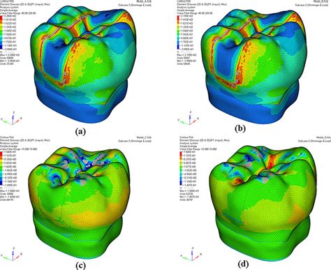 D Stress Magnitudes In Restored Tooth Models A D Download Scientific Diagram
