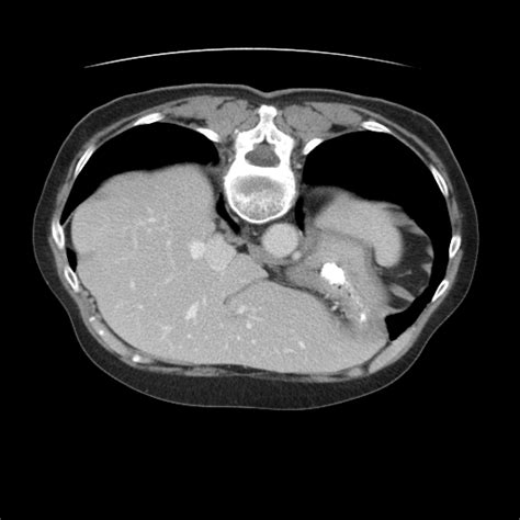 【python】simpleitk 针对于 Lits 数据集，获取最大肝脏面积的切片 Csdn博客