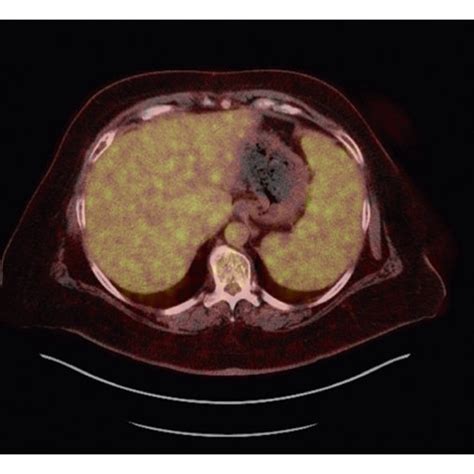 2 2017 Hypermetabolic Activity Within The Subcarinal Lymph Nodes