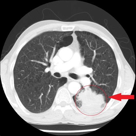 Chest Ct Scan Of Patient 2 Showing Pulmonary Nodules