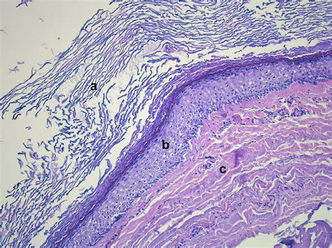 Histopathological Analysis Presenting Intraluminal Keratinized Debris