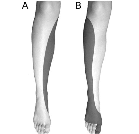 Examples Of Dermatomal Patterns Of Radicular Sciatica Of L4 A And L5 Download Scientific