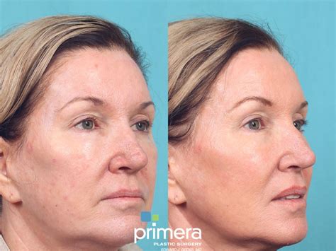 Laser Skin Resurfacing Dot Co2 Before And After Pictures Case 947 Orlando Winter Park