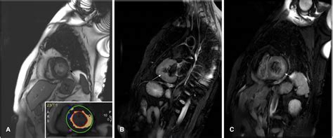 Miocarditis Aguda En La Enfermedad De Shoshin Medicina Clínica