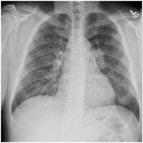 Representative Chest Radiograph PA View Shows Diffuse Fine Download Scientific Diagram