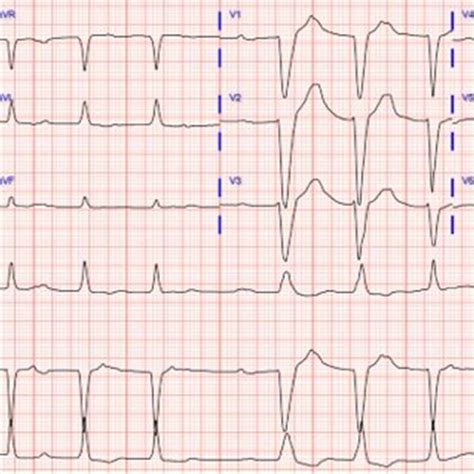 Ecg Showing Low Amplitude Regular Atrial Activity As Well As Download Scientific Diagram