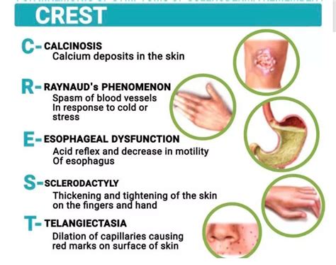 Crest Syndrome Scleroderma Basic Science Orthobullets