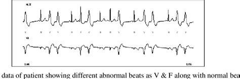 Figure 1 From Ecg Classification And Abnormality Detection Using