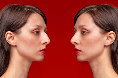 بهترین جراح بینی استخوانی در تهران ایزو ویزیت