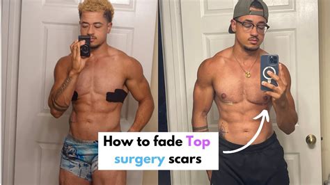 how to fade top surgery scars ftm youtube