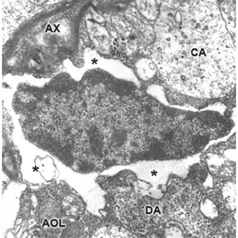 Brain Trauma Right Parieto Temporal Hematoma Severe Edema Right