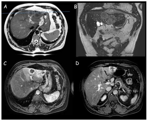 Magnetic Resonance Imaging Of A 3 Cm Intrahepatic Cholangiocarcinoma In Download Scientific