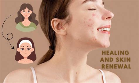 The Mystery Of Itchy Acne Causes Triggers And Relief Tips