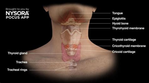 Comparing Proximal And Distal Approaches For Intercostobrachial Nerve Block In Upper Arm Surgery