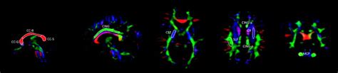 Autism Attenuates Sex Differences In Brain Structure A Combined Voxel