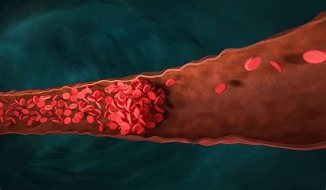 Blood Clots Do You Know The Signs Healthingca