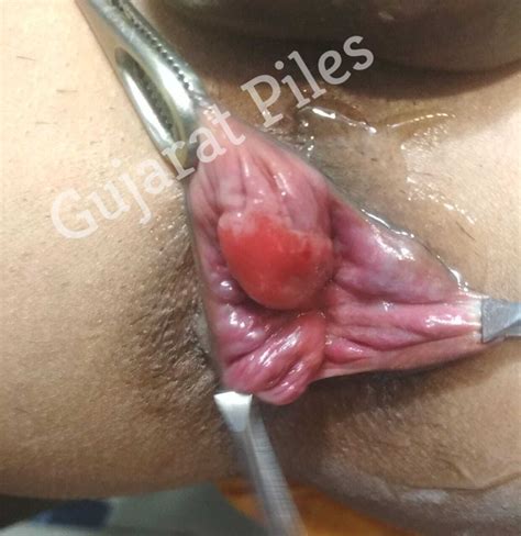 Piles Treatments Gujarat Piles And Gastro Care Center Udaipur