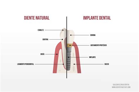 La Diferencia Entre Un Diente Natural Y Un Implante Dental Clínica