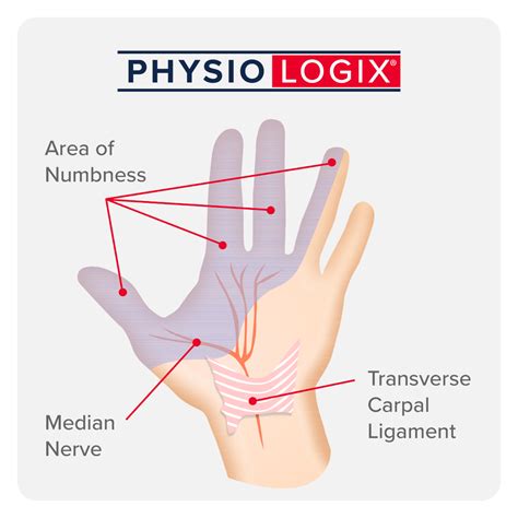 Symptoms And Treatment Of Carpal Tunnel Syndrome Physiologix