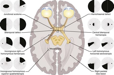 Neuro Ophthalmology Ento Key