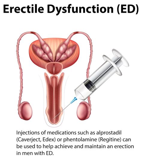Free Vector Erectile Dysfunction Ed Infographic With Explanation