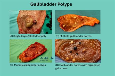 Gallbladder Polyps Singapore Causes Risks And Treatment Options