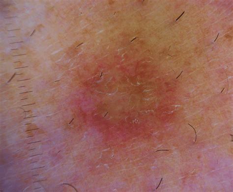 B Dermoscopy Highlights Non Specific Diffuse Scaling Pattern All Over Download Scientific