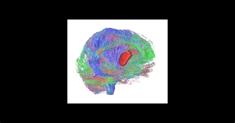 Brain Tumour Dti Mri Scan C017 7057 Science Lover Sticker Teepublic