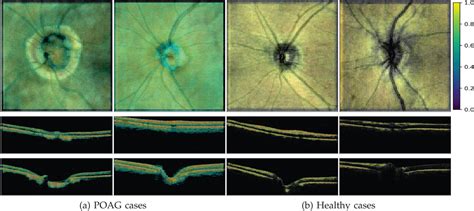 Attention Guided 3d Cnn Framework For Glaucoma Detection And Structural