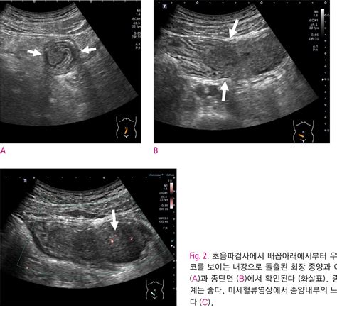Figure 1 From Inflammatory Fibroid Polyp Of Ileum With Intussusception Semantic Scholar