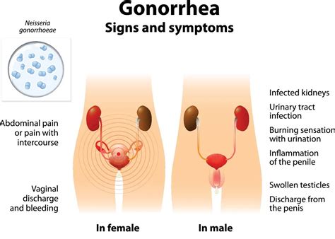 Pathophysiology Of Gonorrhea Diagram