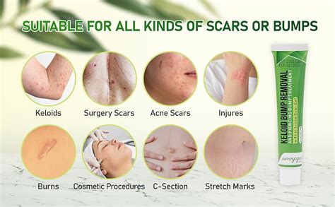 Tobcharm Keloid Scar Removal Keloid Bump Removal For Scar