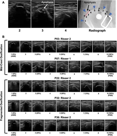 Using B Mode Ultrasound To Evaluate Risser Grading For The