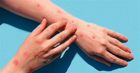 Texas Hosts First Monkeypox Death In The Us Reform Austin