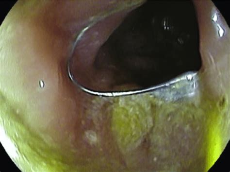 Sigmoidoscopic View Showing Patent Rectosigmoid Junction After Stent