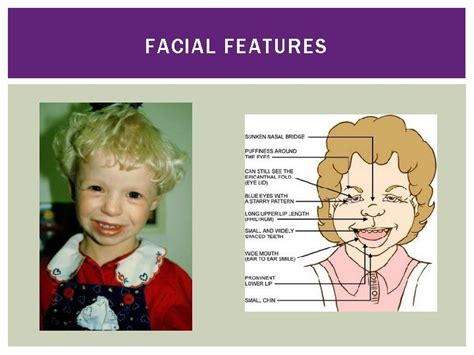 Williams Syndrome And Occupational Therapy Sarah Dobbs Msots
