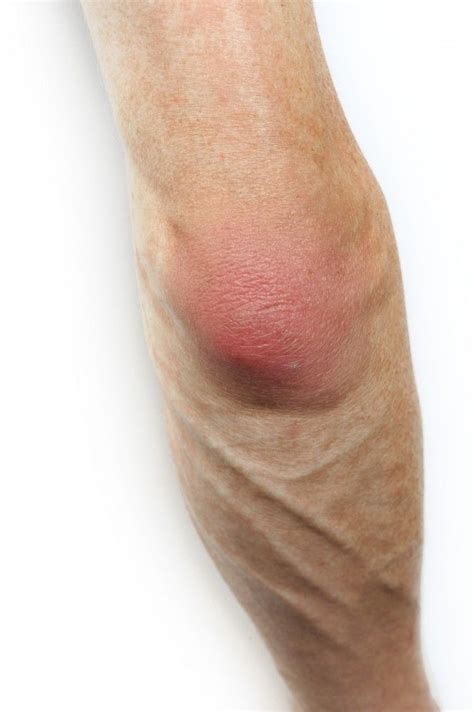 Bursitis Bone Joint And Muscle Disorders Msd Manual Consumer Version